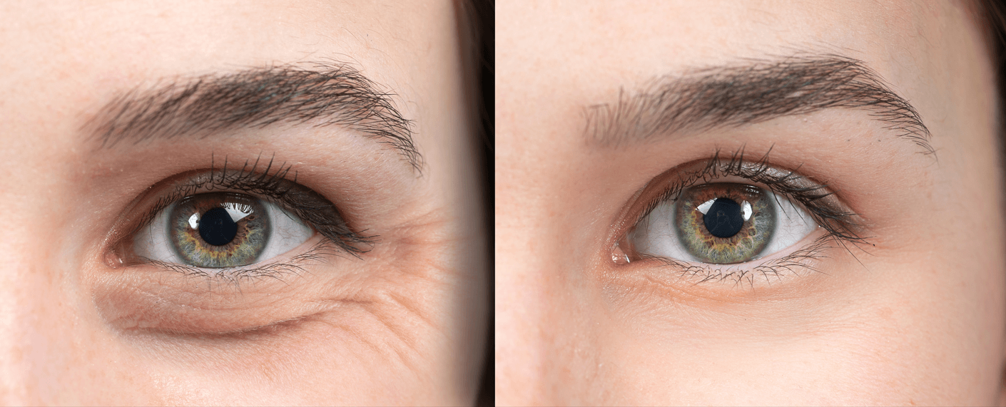 Crow’s Feet – Quality Care Doctors Medskin Clinic